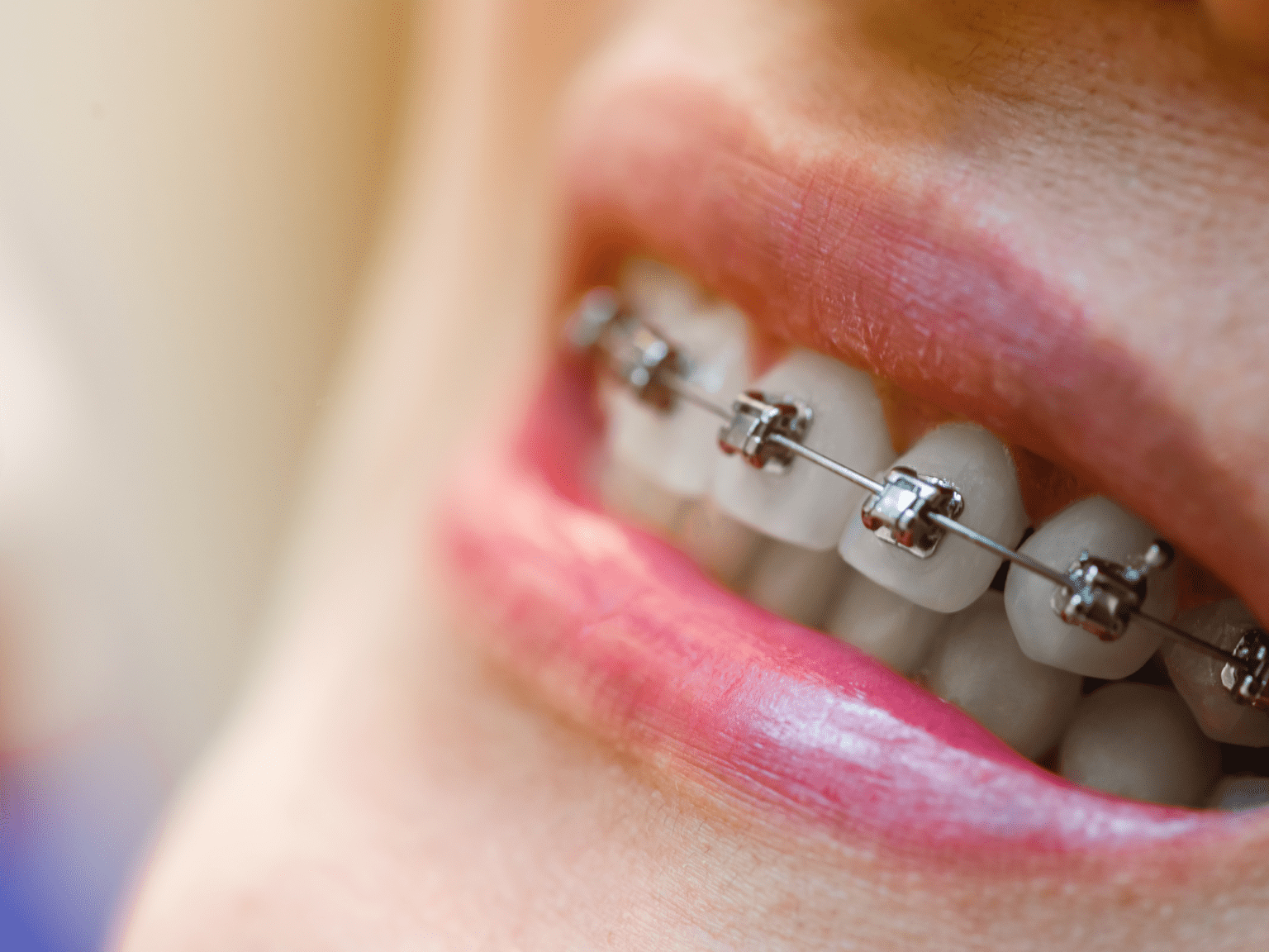 Behel Self Ligating: Kelebihan dan Tahap Pemasangan - Neo Art Dental