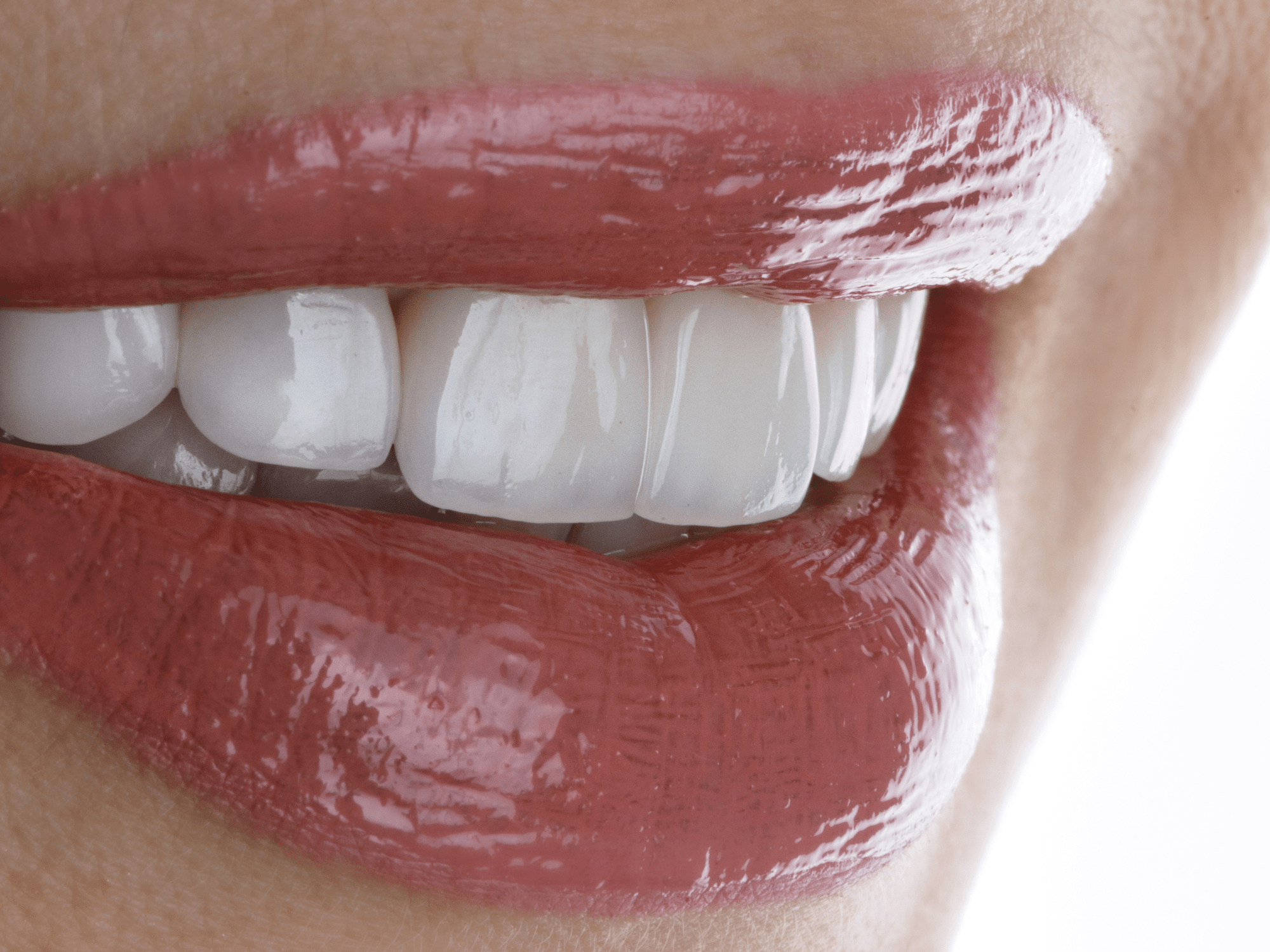 Apa Veneer Gigi? Panduan Lengkap dari Neo Art Dental Center - Neo Art ...