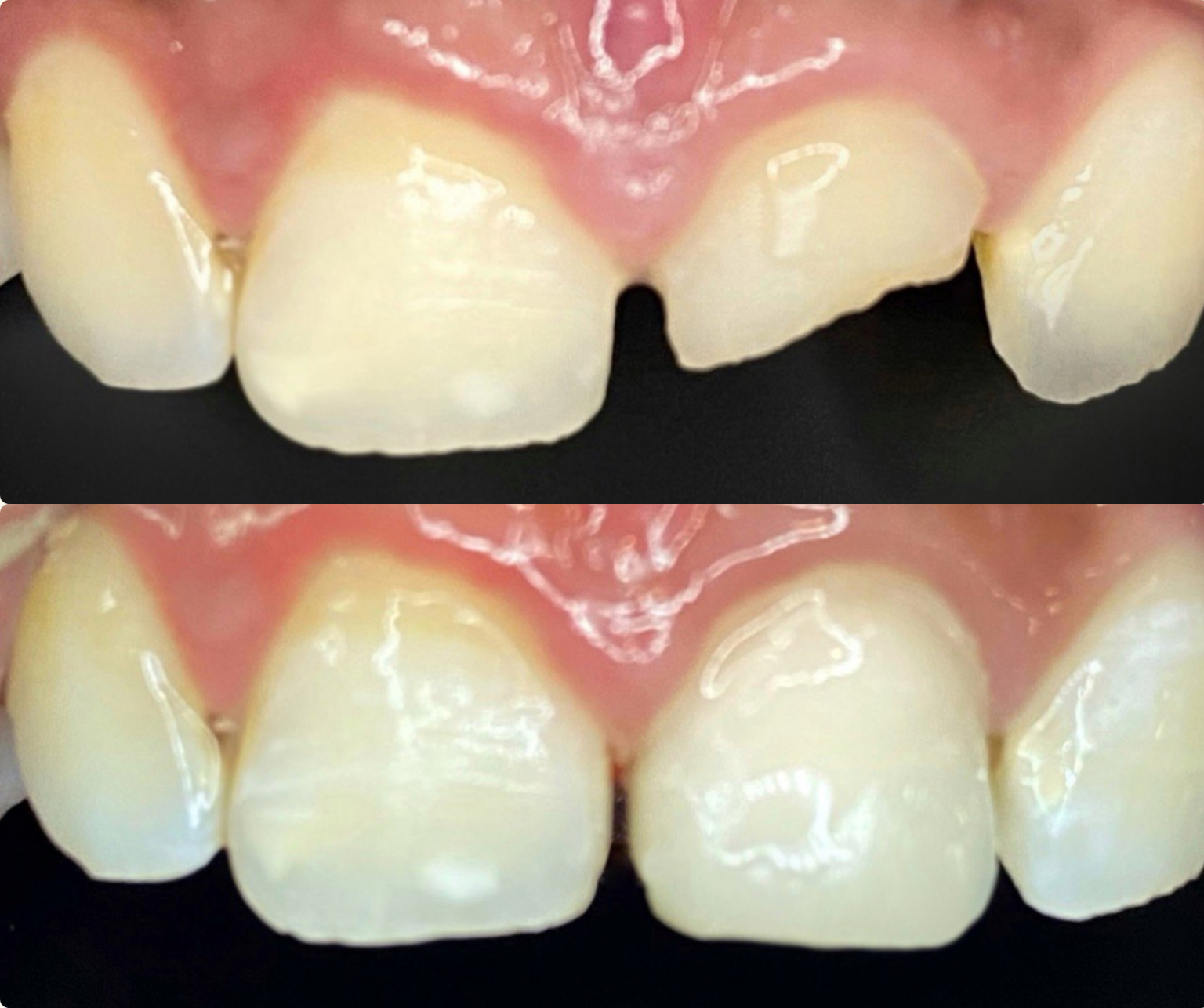 Gigi Anak Patah? Penambalan Gigi Anak Bisa Jadi Solusinya! - Neo Art Dental